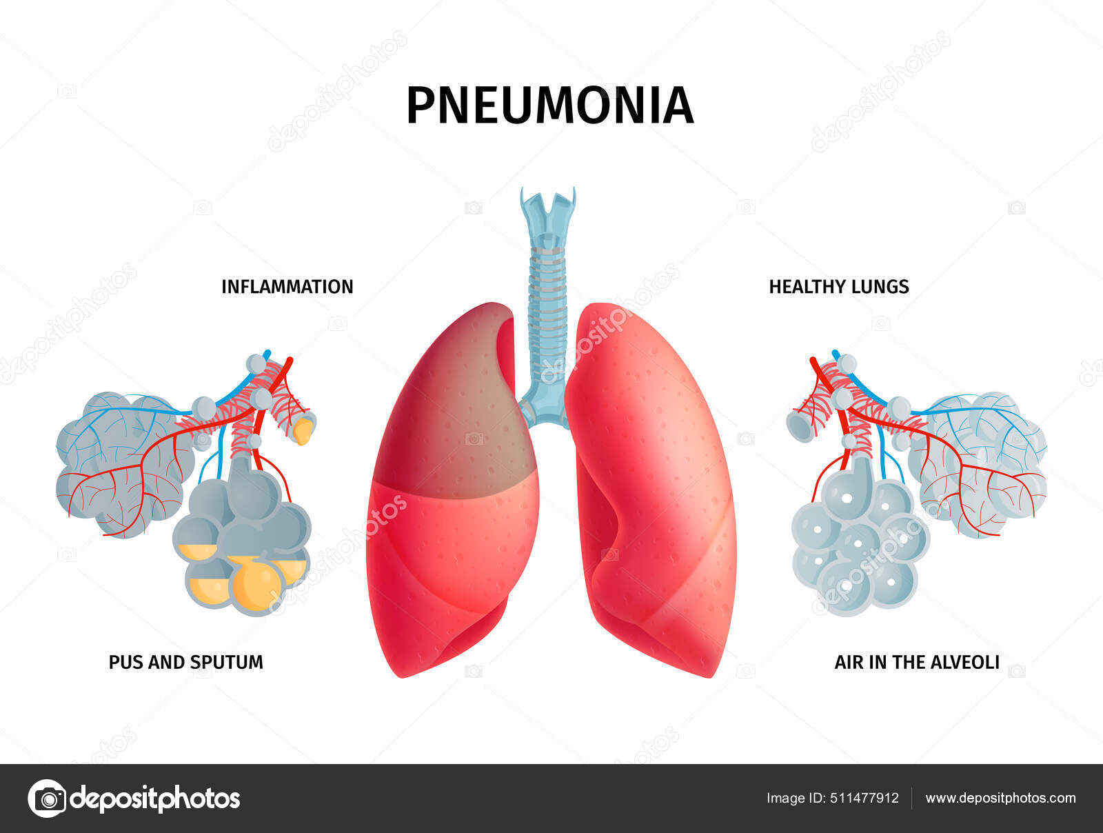 Pneumonia Lungs Diagram