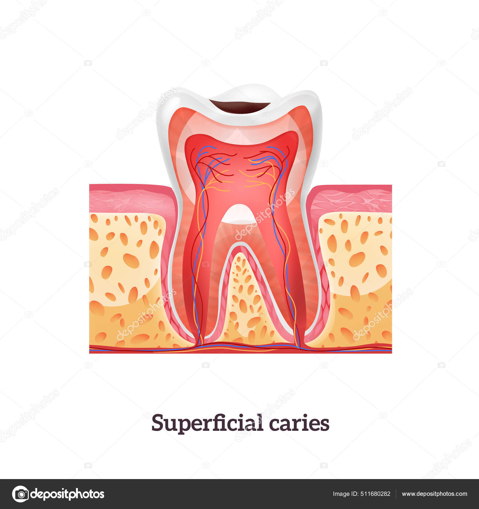 Caries Tooth Anatomy Stock Vector Image by ©macrovector #511680282