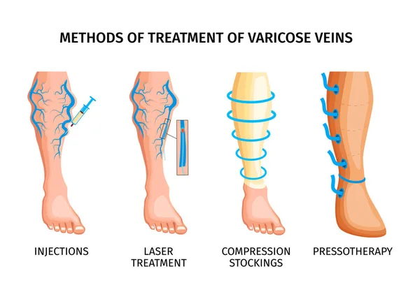 Methods of treatment of varicose veins realistic poster depicting ...