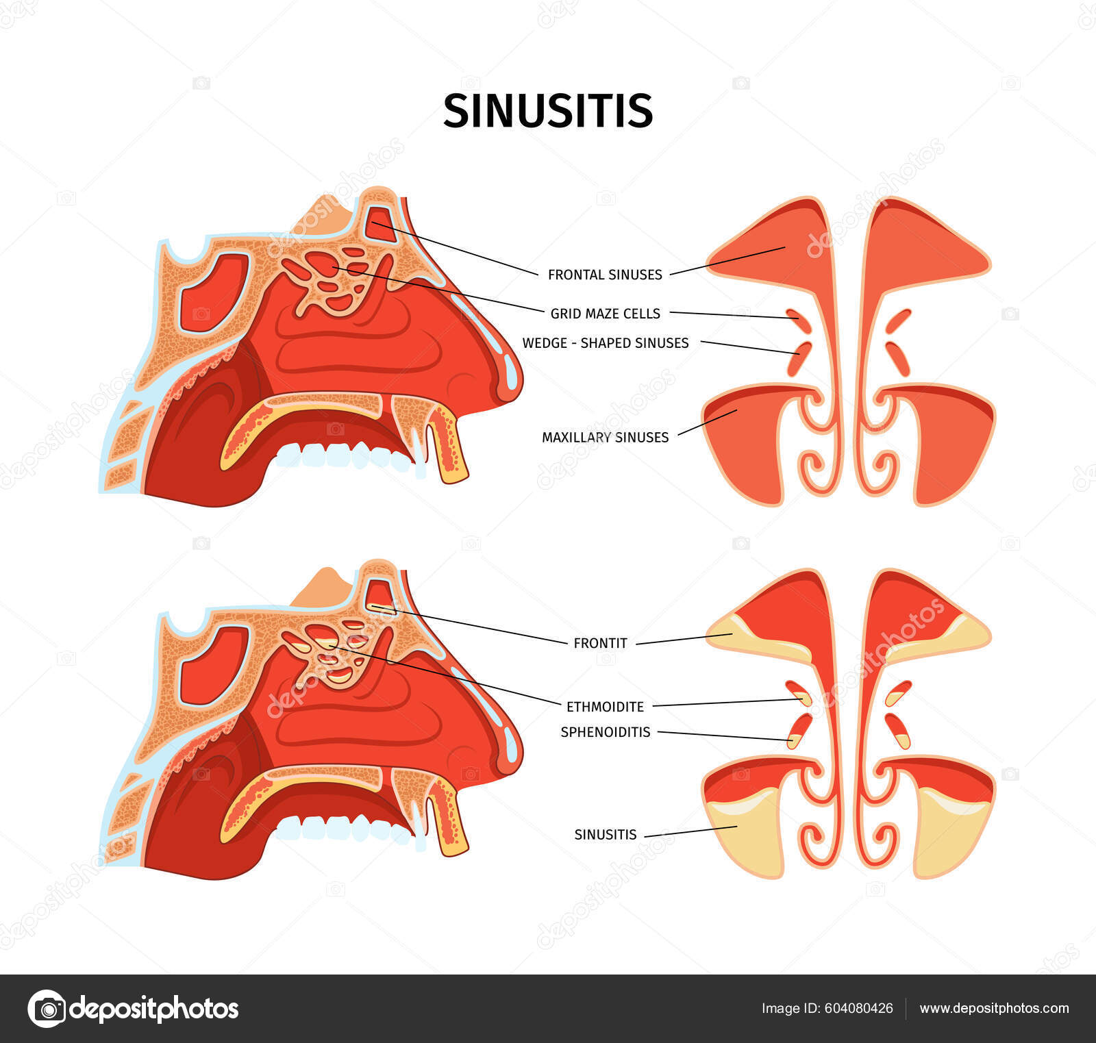 Sinusitis Infographics Cross Section Poster Depicting Inflammation ...