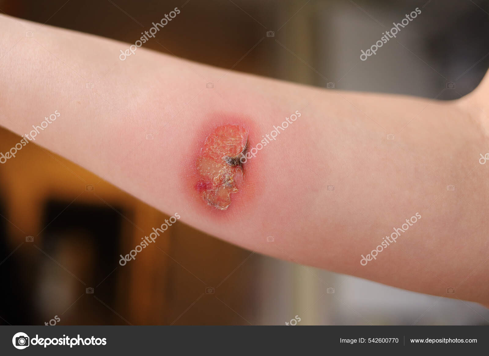 Third Degree Burn