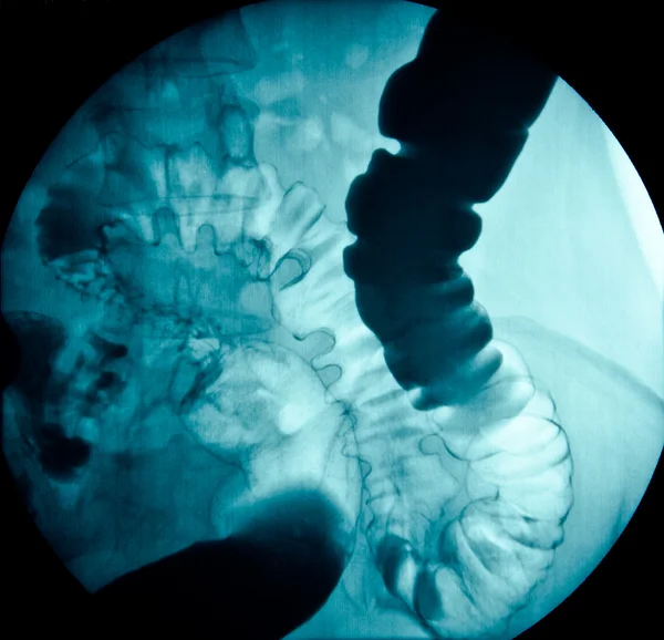 Kanker van de endeldarm Stock Photos, Royalty Free Kanker van de ...