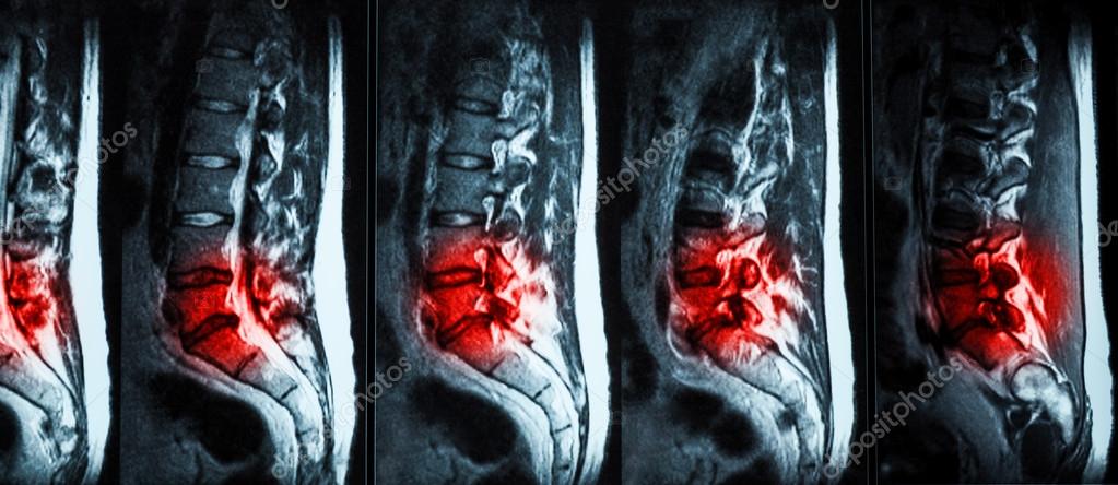 Ressonância magnética (RM) de coluna lombo-sacral mostr — Fotografia de ...