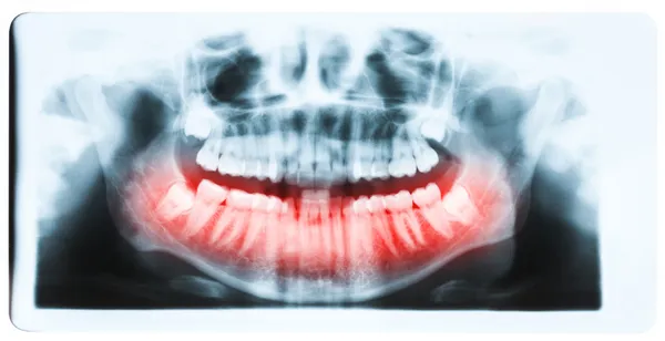 Panoramic x-ray image of teeth and mouth with all four molars ve ...
