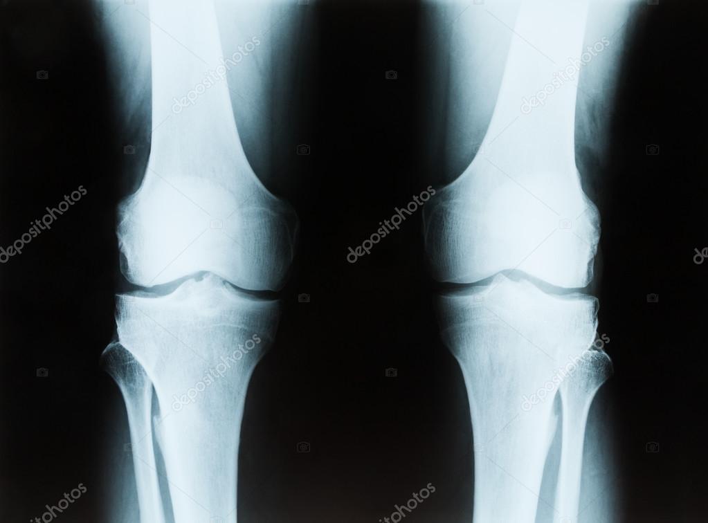 Radiographie d'un genou gauche et droit masculin senior montrant tibia ...