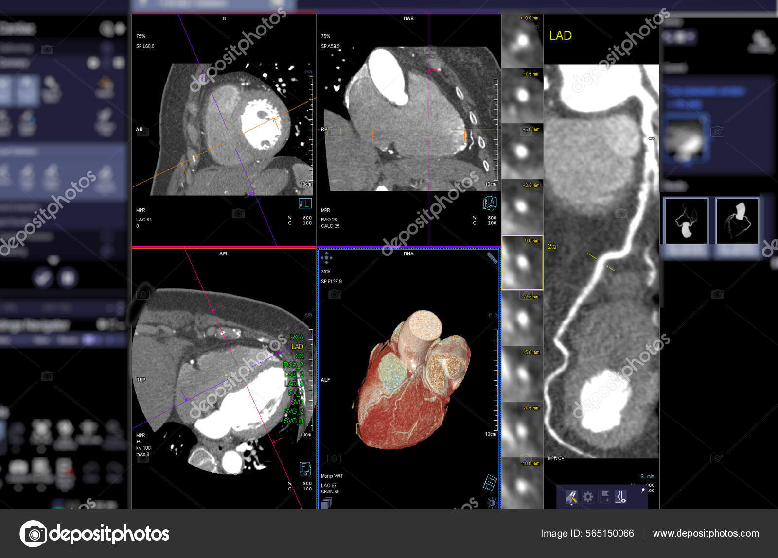 Cta Coronary Artery Rendering Image Screen Diagnosis Vessel Coronary ...