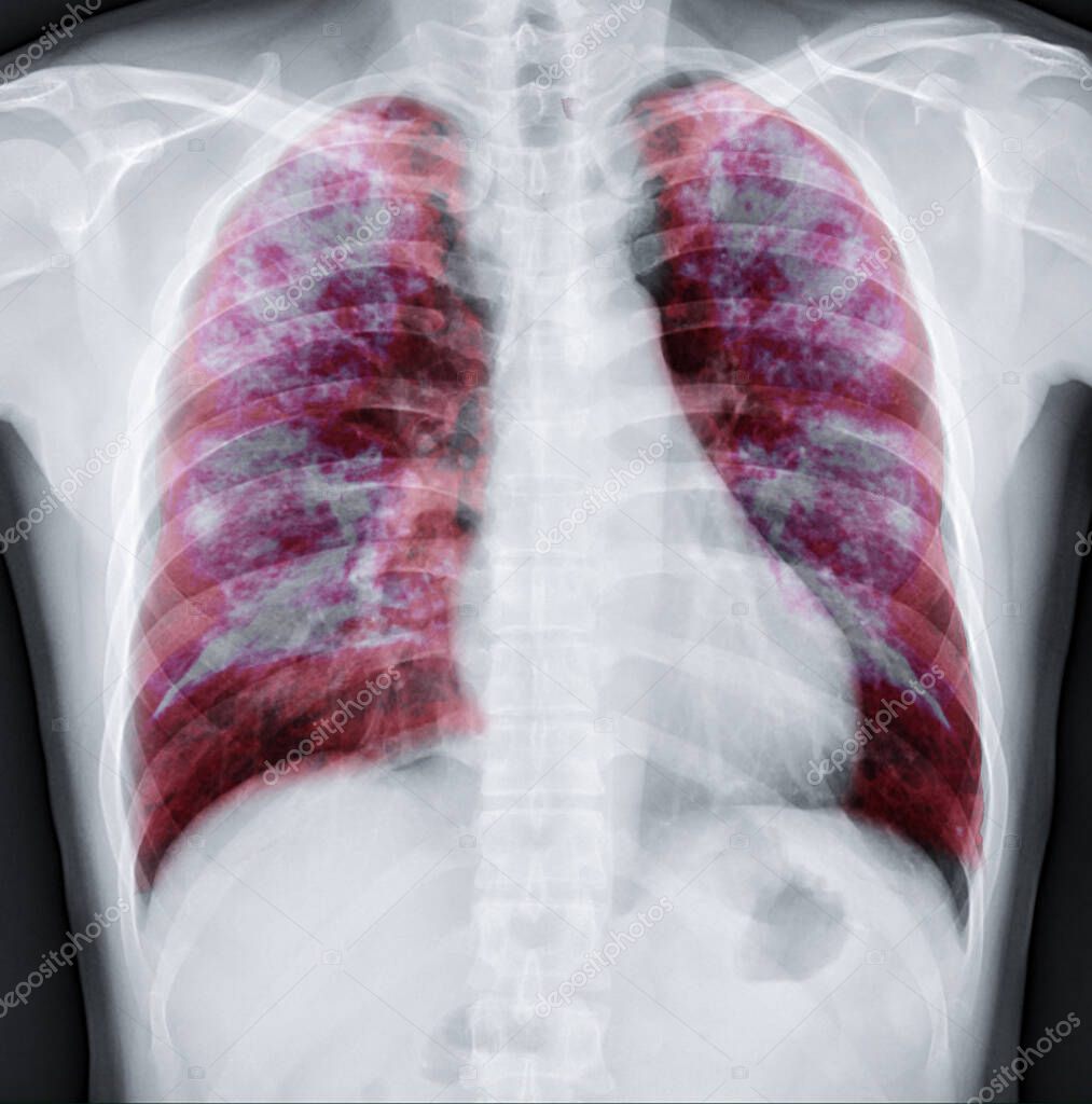 Radiografía de tórax con imagen de renderizado 3D pulmonar para el ...
