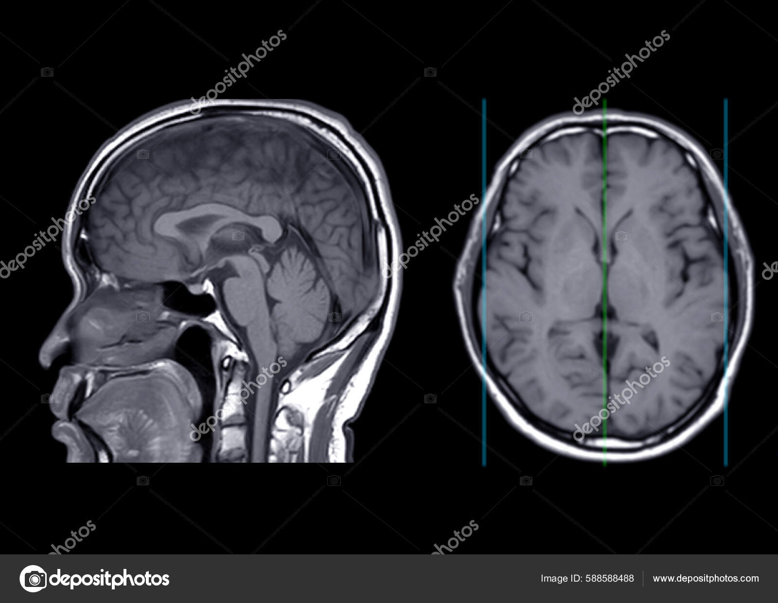 Sagittal View Of Brain Mri