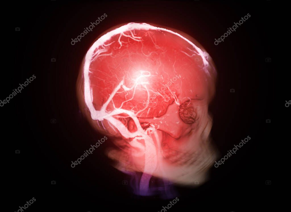 Skull 3D with CTV Brain showing Dural venous sinuses for diagnosis ...