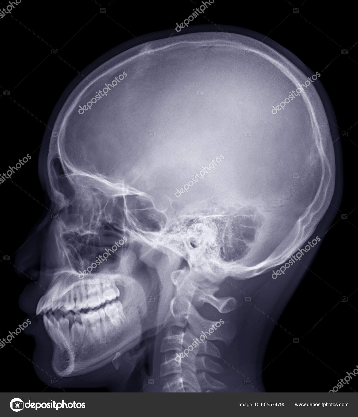 X Ray Skull Lateral View Collection Of Skull X Ray Image Of Human