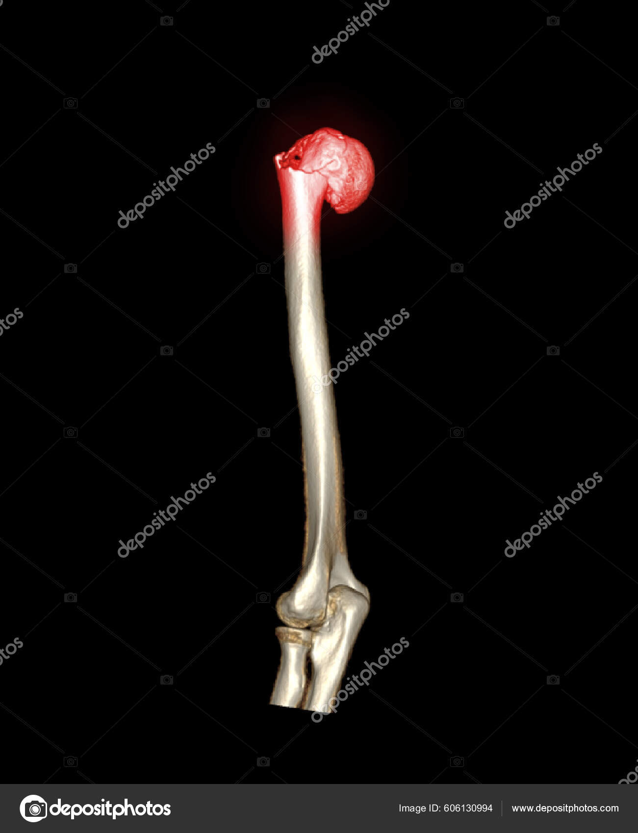 Computed Tomography Volume Rendering Examination Shoulder Joint Humerus ...