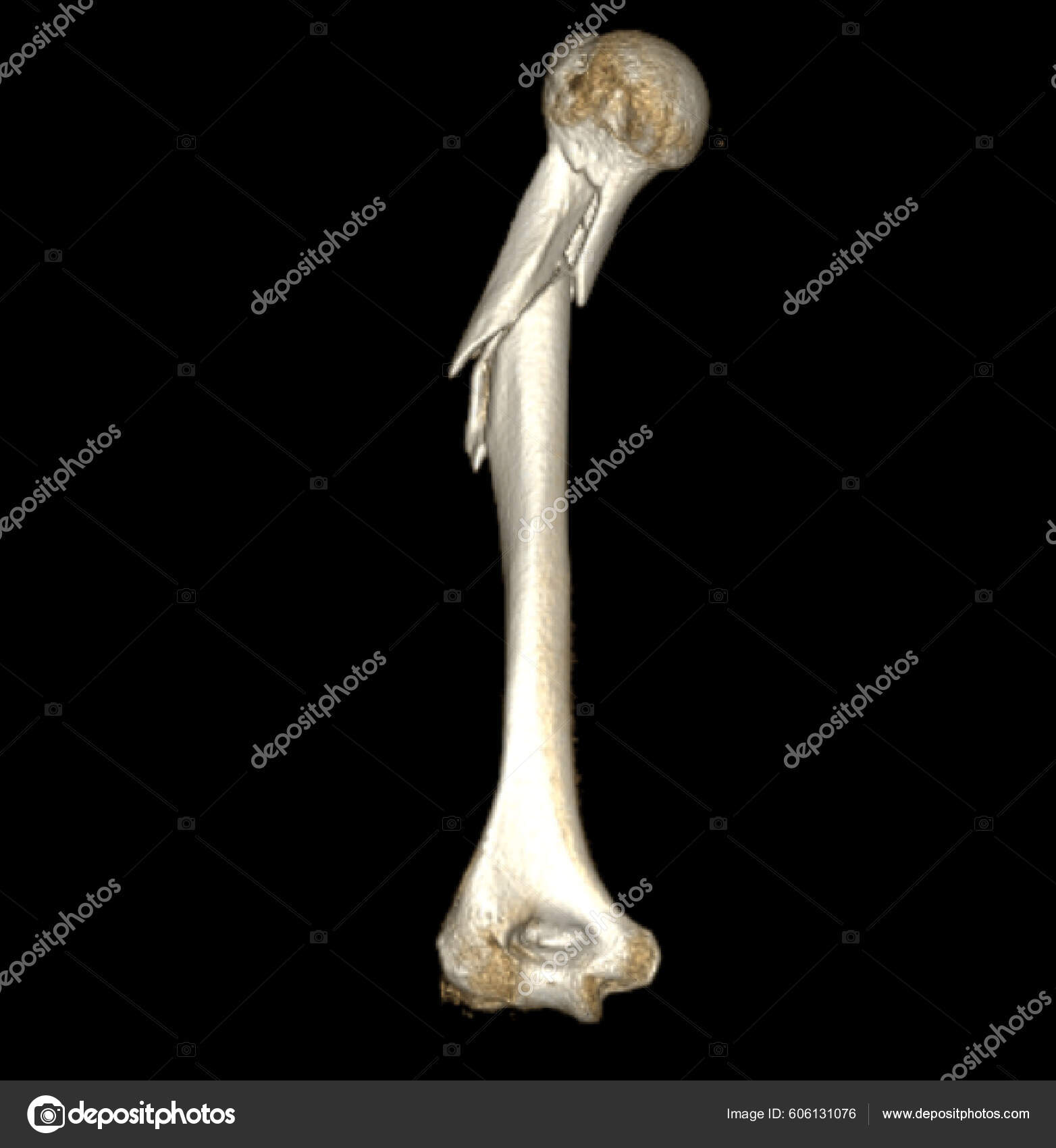 Computed Tomography Volume Rendering Examination Shoulder Joint Humerus ...