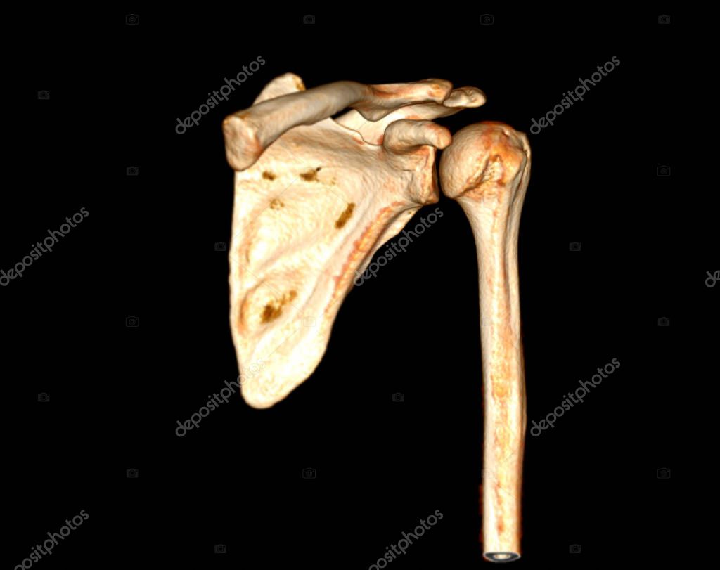 Computed Tomography Volume Rendering examination of the Shoulder 3D ... Computed Tomography Volume Rendering examination of the Shoulder 3D ...