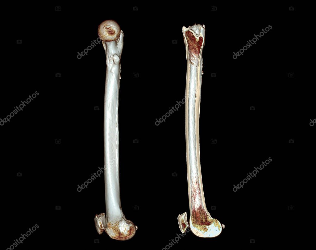 Tomografía computarizada de fémur del hueso del muslo Imagen de ...