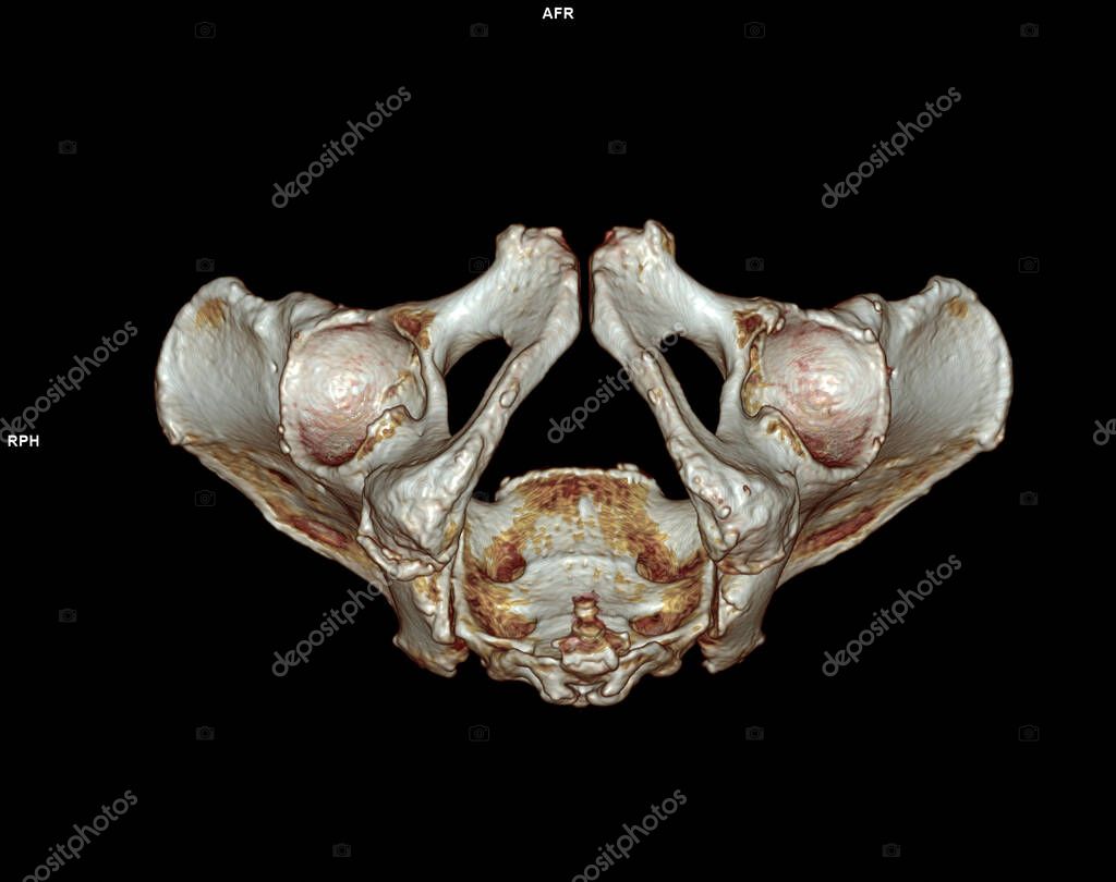 Tomografía computarizada de hueso pélvico y articulación de cadera ...
