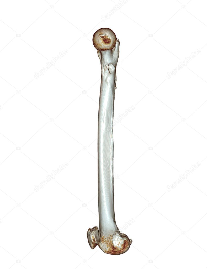 Tomografía computarizada del hueso del fémur og hueso del muslo ...