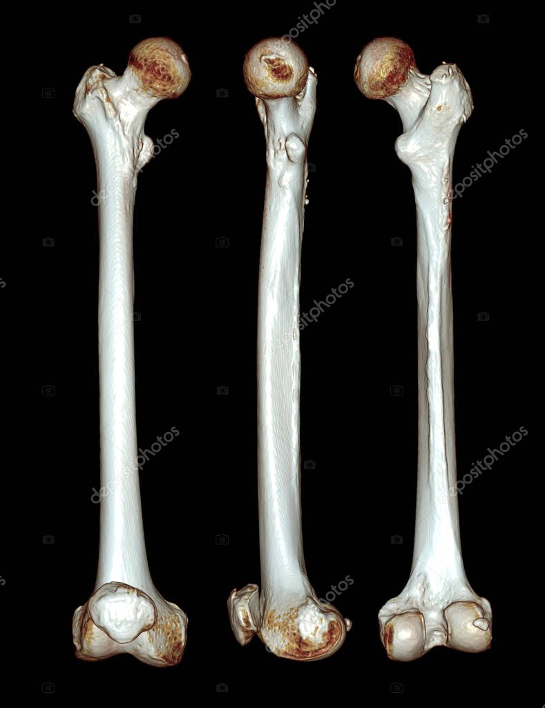 Tomografía computarizada del hueso del fémur og hueso del muslo ...