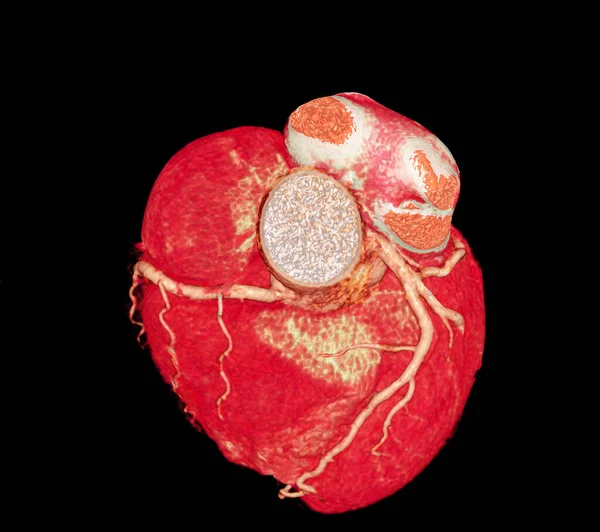 Cardiac Rendering Nebo Cta Koronární Tepna Pro Prevenci Ischemické ...
