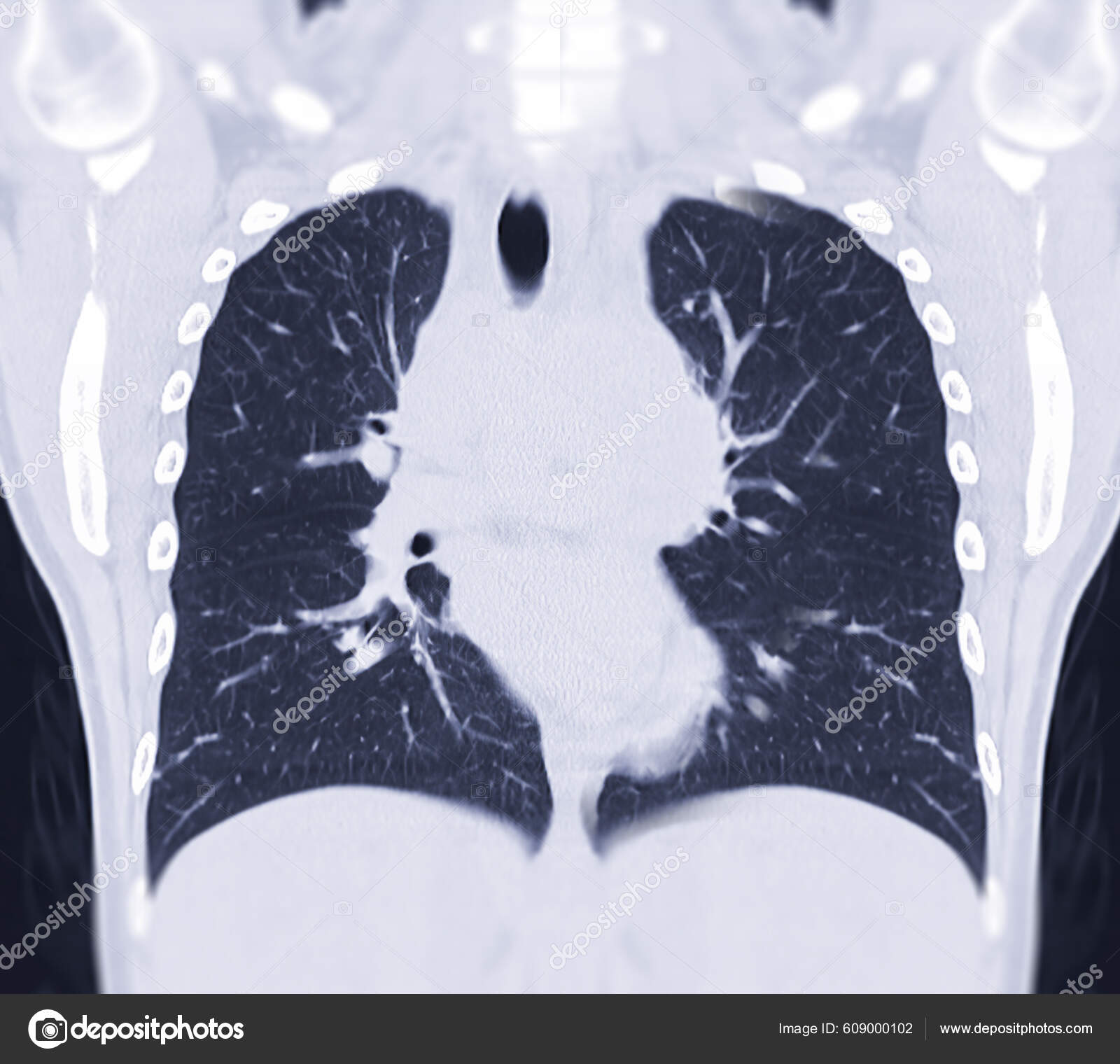 Chest Coronal Mip View Diagnostic Pulmonary Embolism Lung Cancer Covid ...