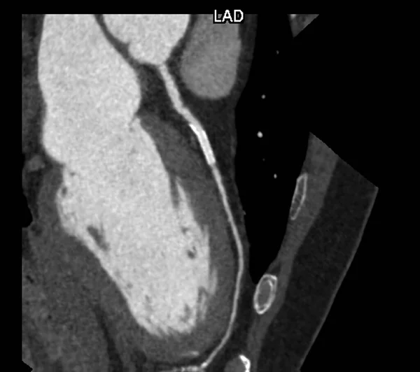 Cardiac Cta Coronary Artery Prevention Coronary Artery Diseases — Stock ...