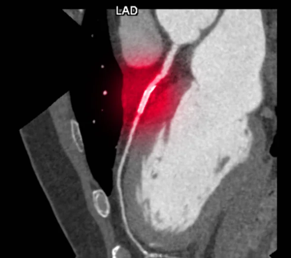 Cardiac Cta Coronary Artery Prevention Coronary Artery Diseases — Stock ...