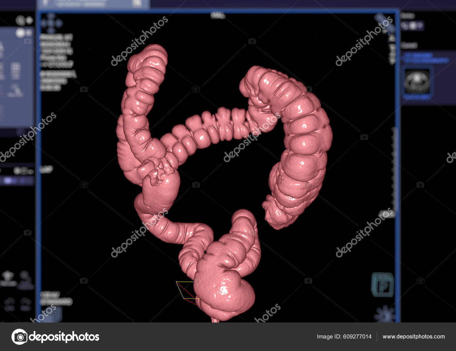 Colonography Colonography Rendering Image Diagnosis Colon Cancer ...