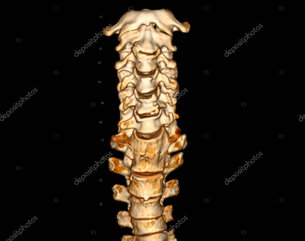 Tomografía computarizada de columna C o columna cervical 3D para el ...