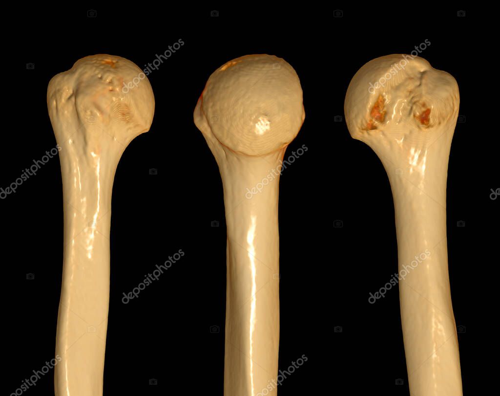 Tomografía computarizada de la cabeza del húmero 3D de tomografía ...