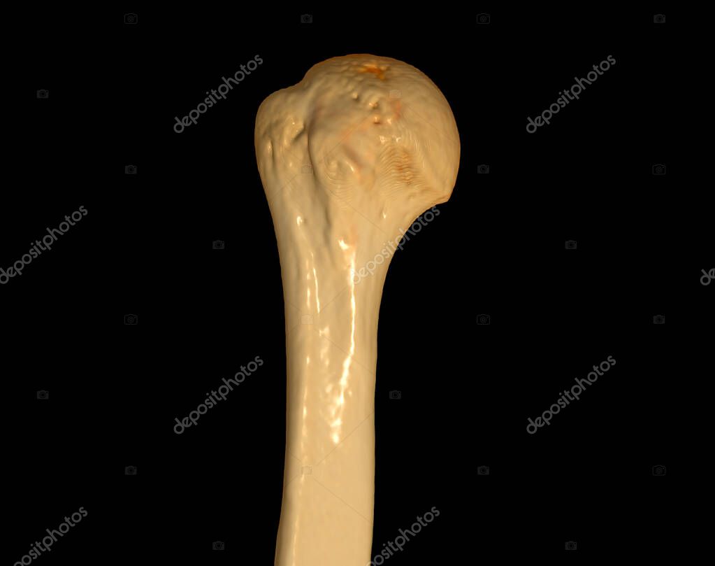 Tomografía computarizada de cabeza de húmero 3D de tomografía ...