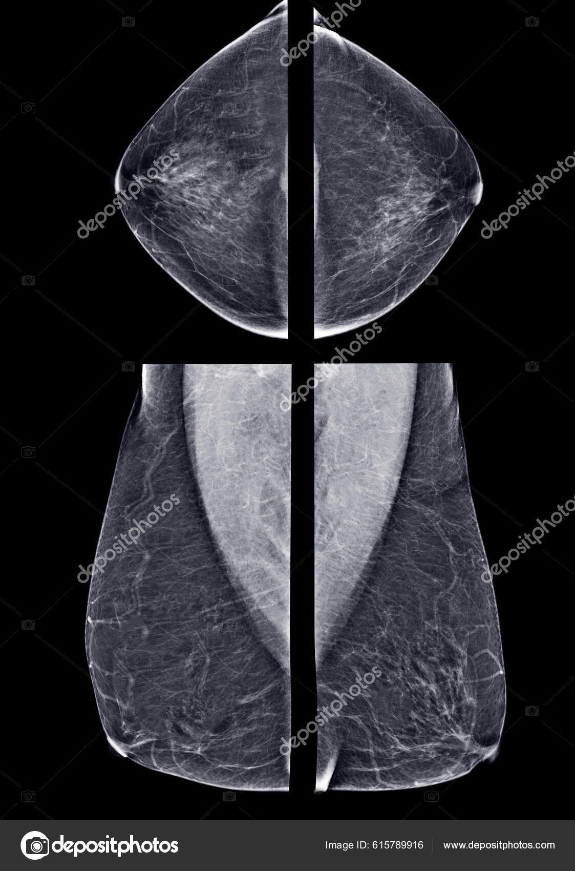 Ray Digital Mammogram Mammography Both Side Breast View Mlo Screening ...