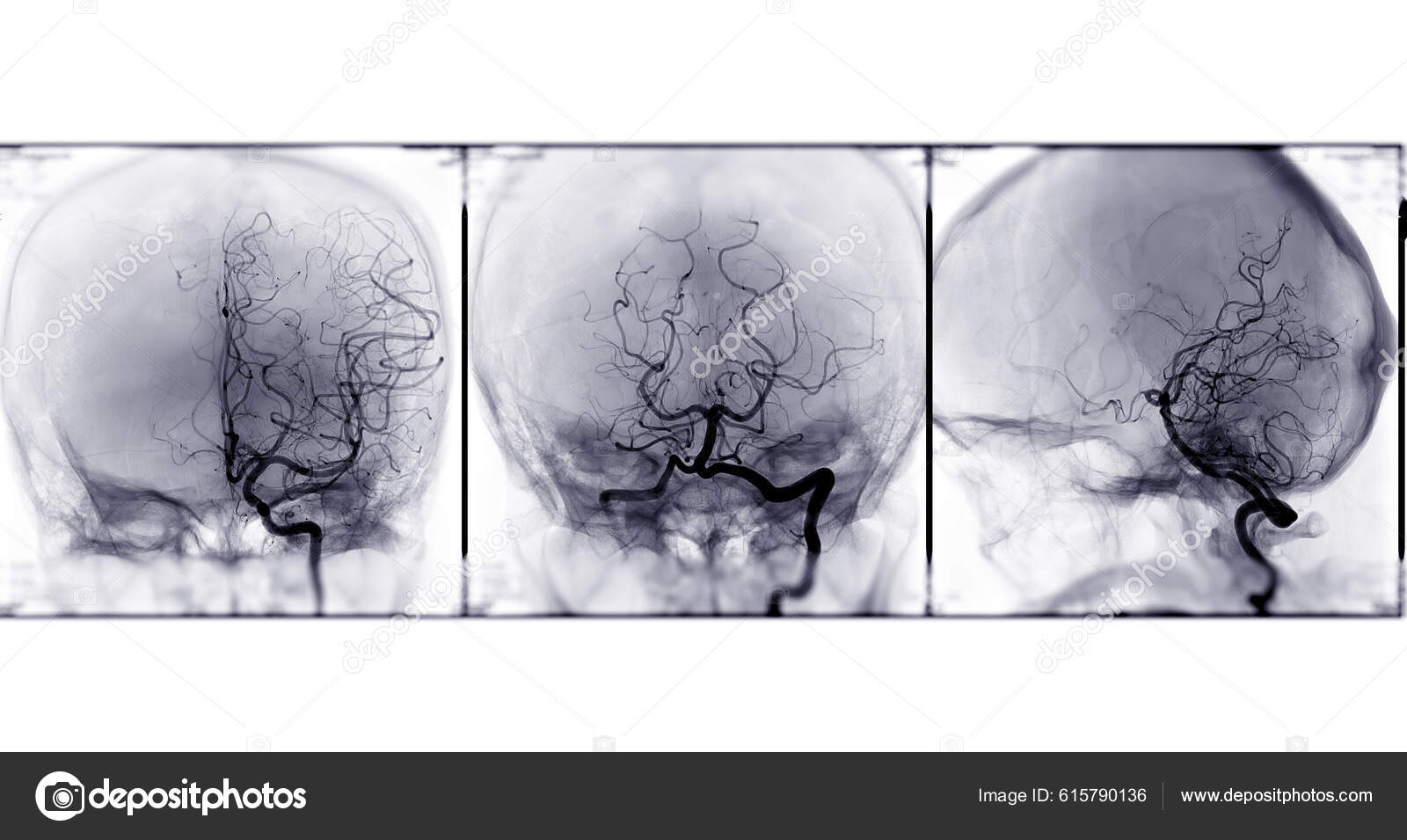 Collection Cerebral Angiography Rendering Showing Cerebral Artery Stock ...