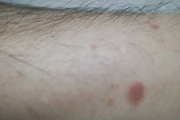 Black death rash Stock Photos, Royalty Free Black death rash Images ...