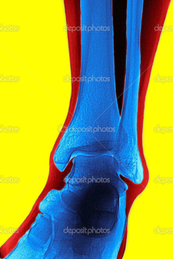 Radiografía de la tibia — Foto de stock #44393945 © imagepointfr