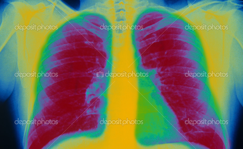Thorax radiograph Stock Photo by ©imagepointfr 44394285