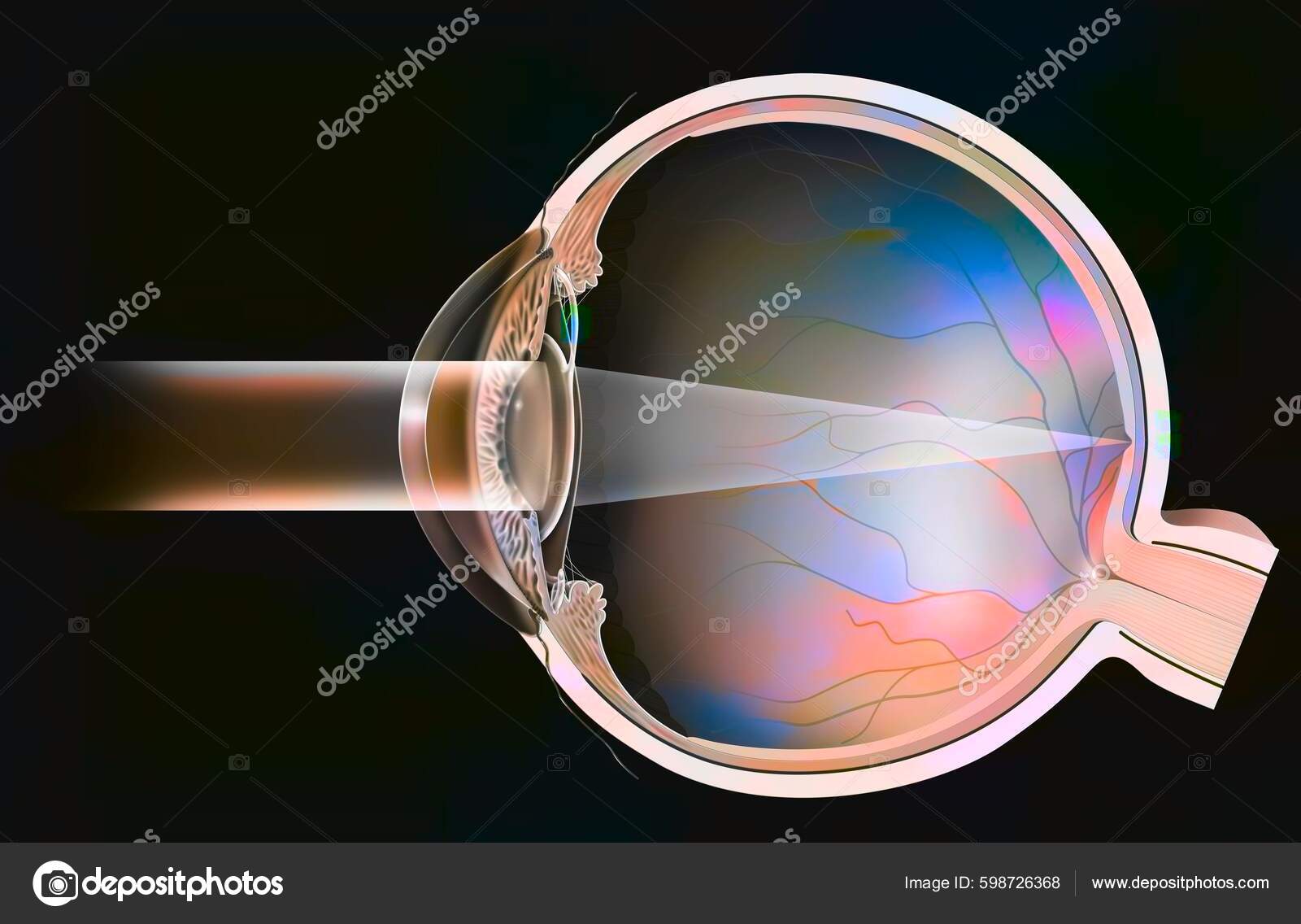 Eye Surgery Intraocular Implant Correct Cataracts — Foto © imagepointfr ...