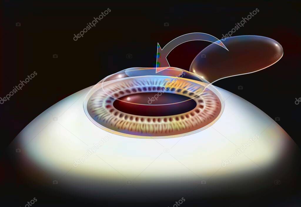 Eye, surgery, Lasik step 4: the corneal flap is put back in place. 2024