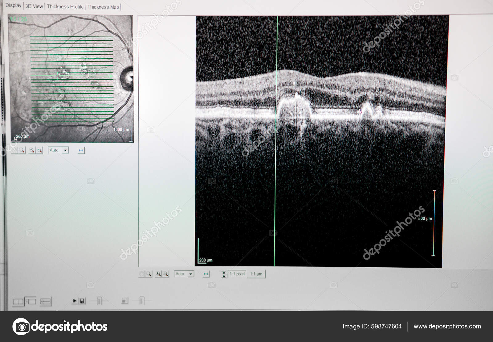 Optical Coherence Tomography Oct Showing Beginnings Macular ...