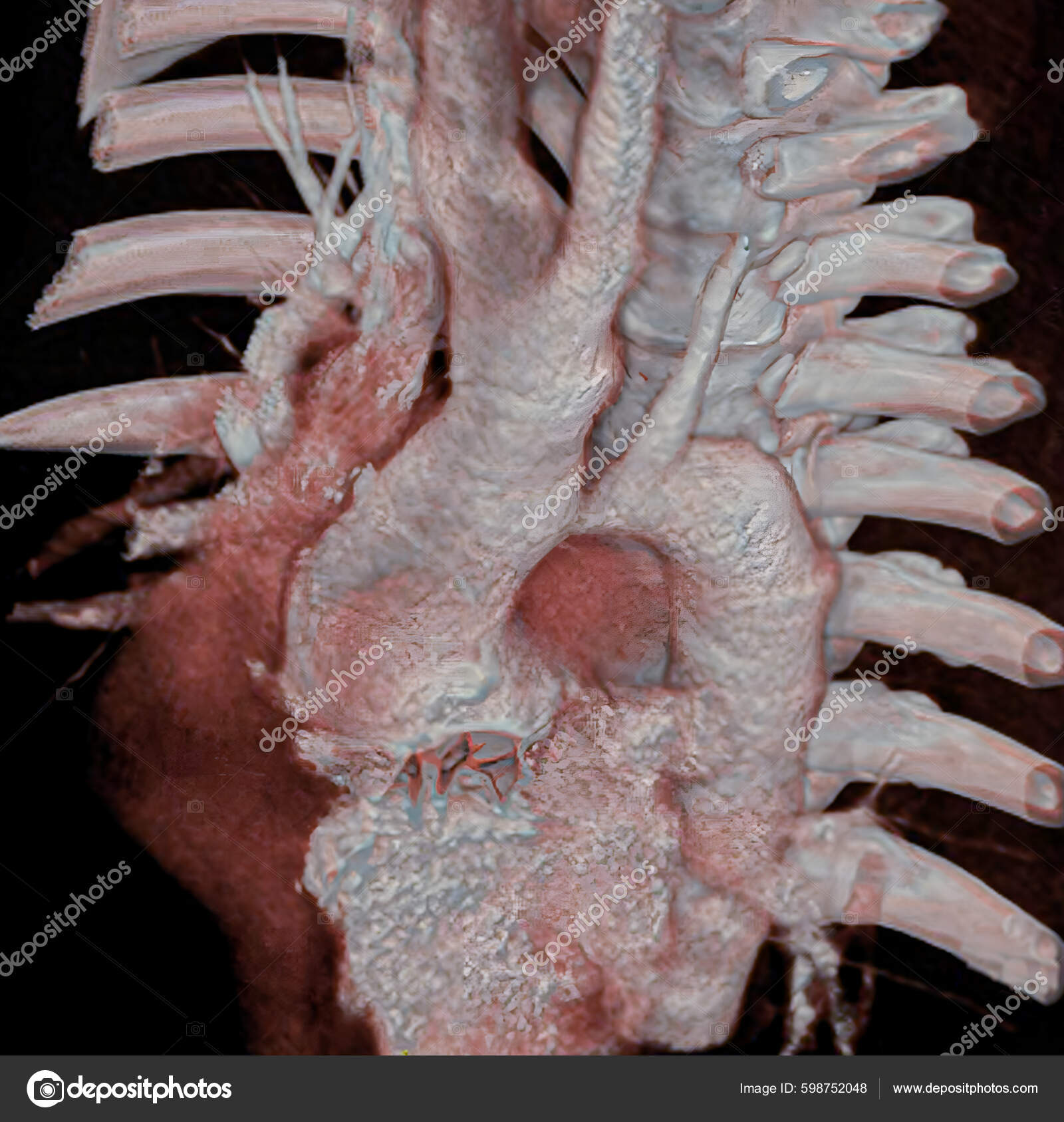 Aortic Coarctation Narrowing Aorta Often Considerable Sometimes ...