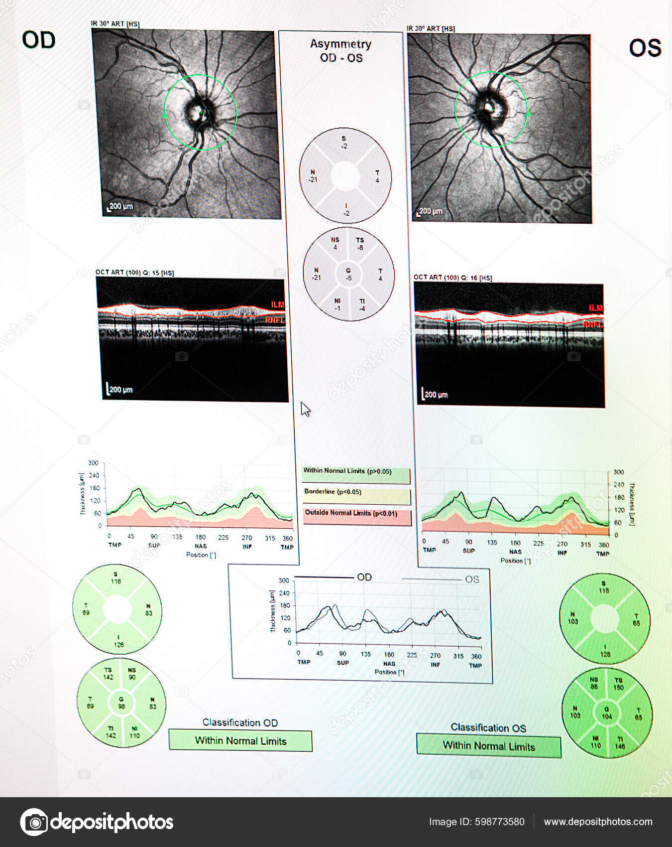 Optical Coherence Tomography Oct Showing Optic Nerve Patient Risk ...