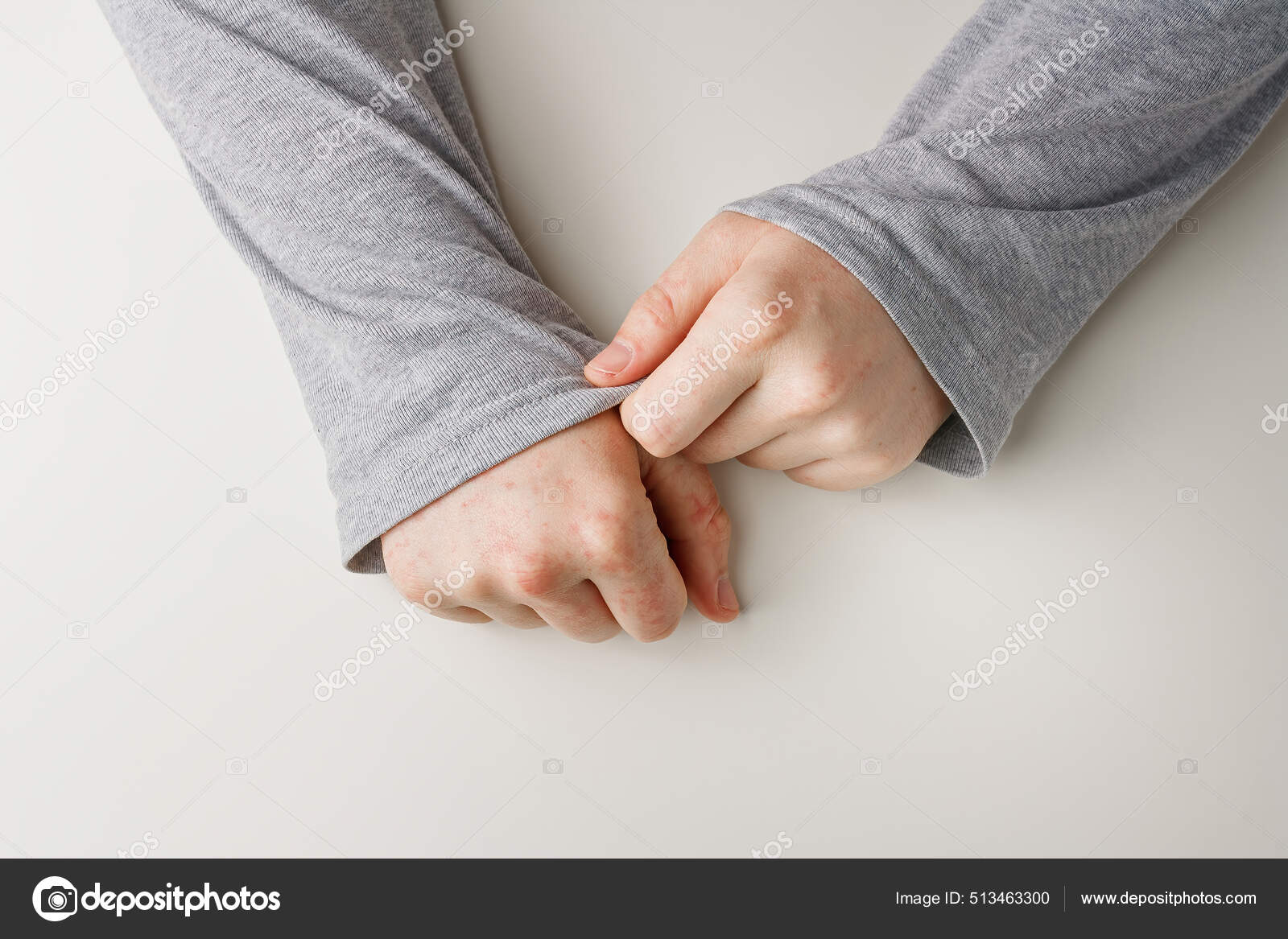 Person Hiding Hands Red Spots Skin Grey Sleeves Allergic Reaction ...