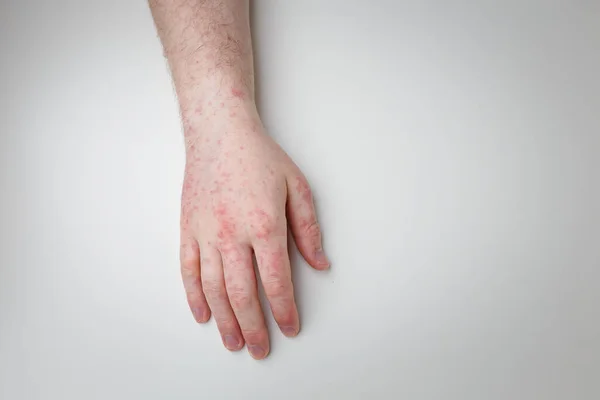 Skin disease research images libres de droit, photos de Skin disease ...