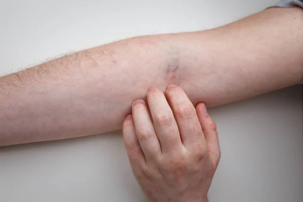 Hematoma arm Stock Photos, Royalty Free Hematoma arm Images | Depositphotos