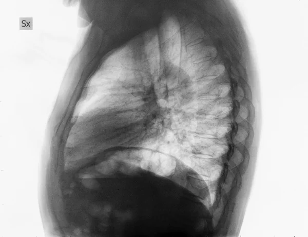 X-ray lungs: Lobectomy of the upper lobe of the left lung post cancer ...
