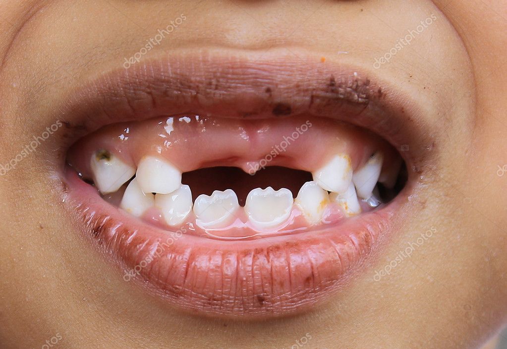 Little boy and broken teeth ⬇ Stock Photo, Image by © Gap #49977523