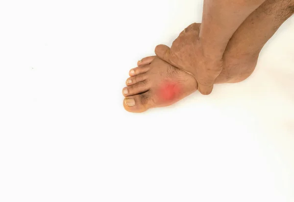 Foot Disease Rheumatism Gout Red Leg Swelling Pain Foot Stock Photo by ...
