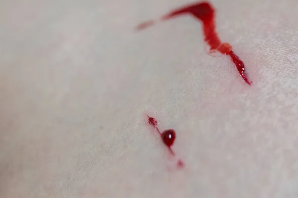 Razor burns Stock Photos, Royalty Free Razor burns Images | Depositphotos