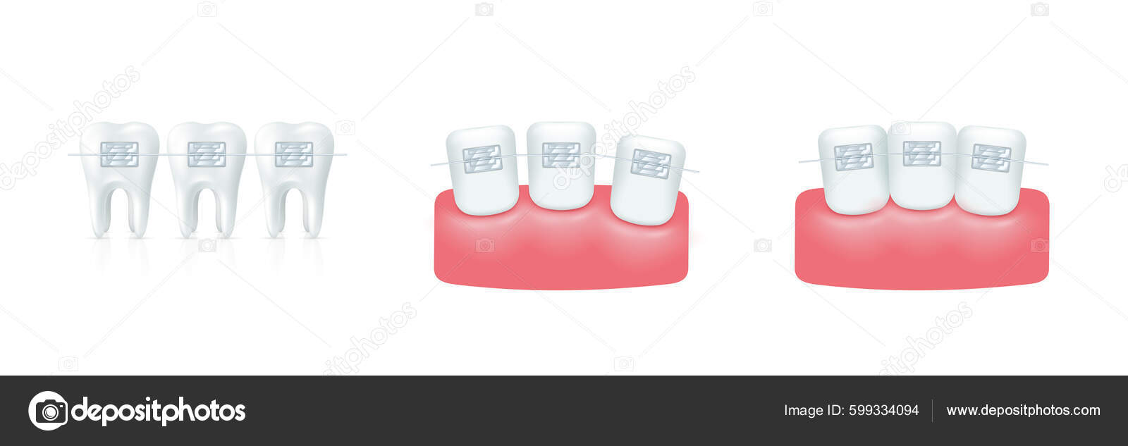 Teeth Braces Set Orthodontic Dentistry Alignment Tooth Elements Healthy ...