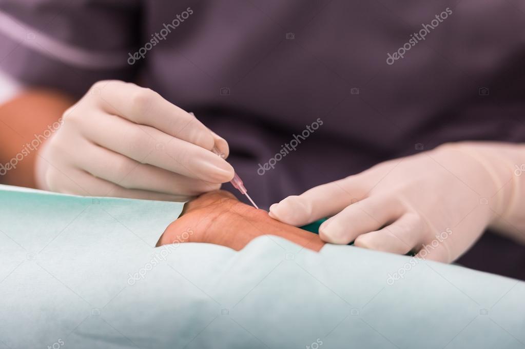 Punción de arteria radial para monitor de línea arterial 2024