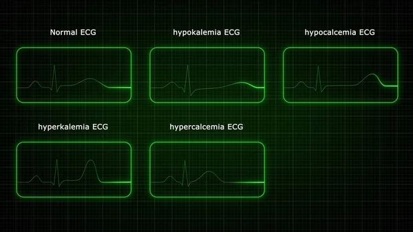 Ilustración 3D de todos los ECG, hipoglucemia, hiperpotasemia, hipocalcemia e hipopotasemia 2024