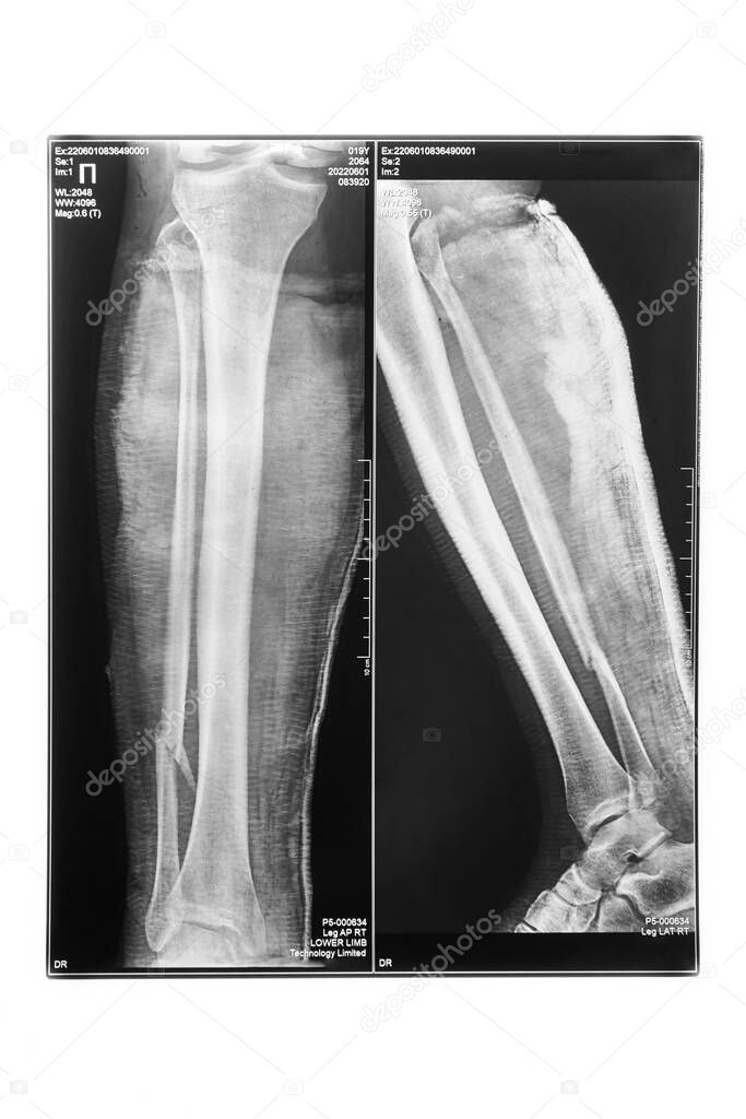 Radiografía de una fractura conminuta de la parte inferior de la pierna ... Radiografía de una fractura conminuta de la parte inferior de la pierna ...